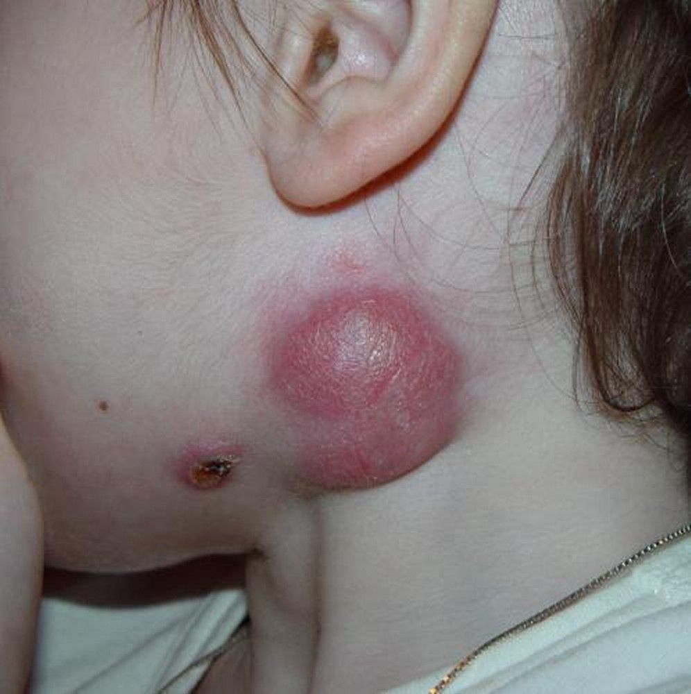 severe lymphadenitis
