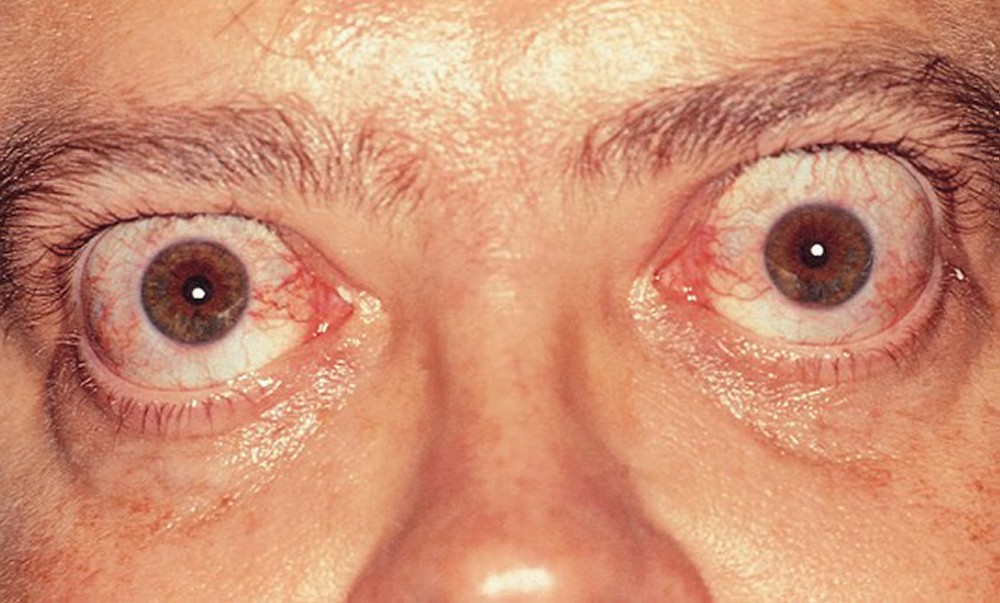 bulging eyeballs causes