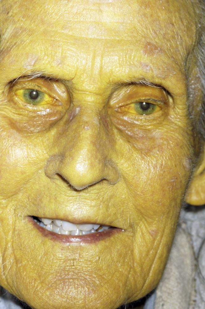 yellowish skin cause