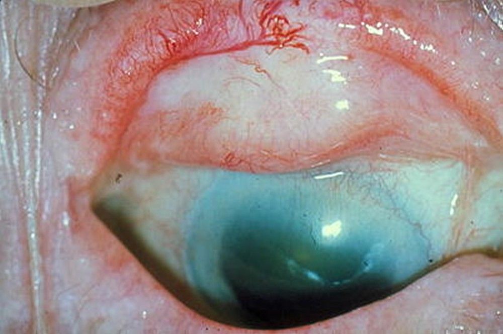 trachoma features